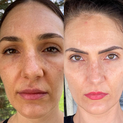 MELASMA TREATMENT – GSC BB